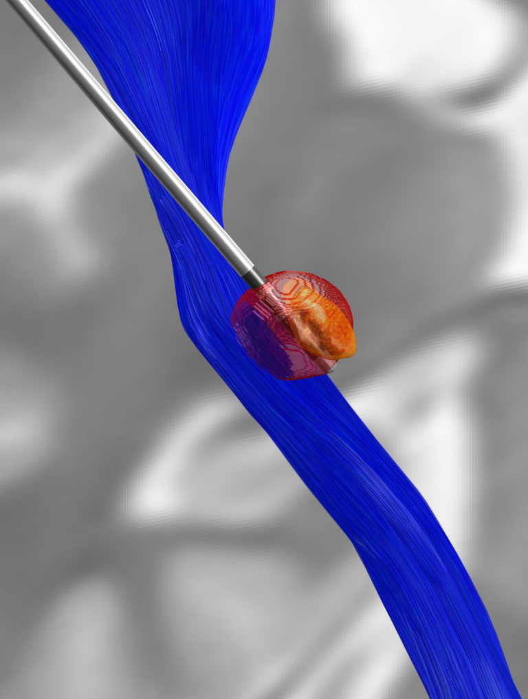 Lead-DBS v2.0 is out now! – Lead-DBS