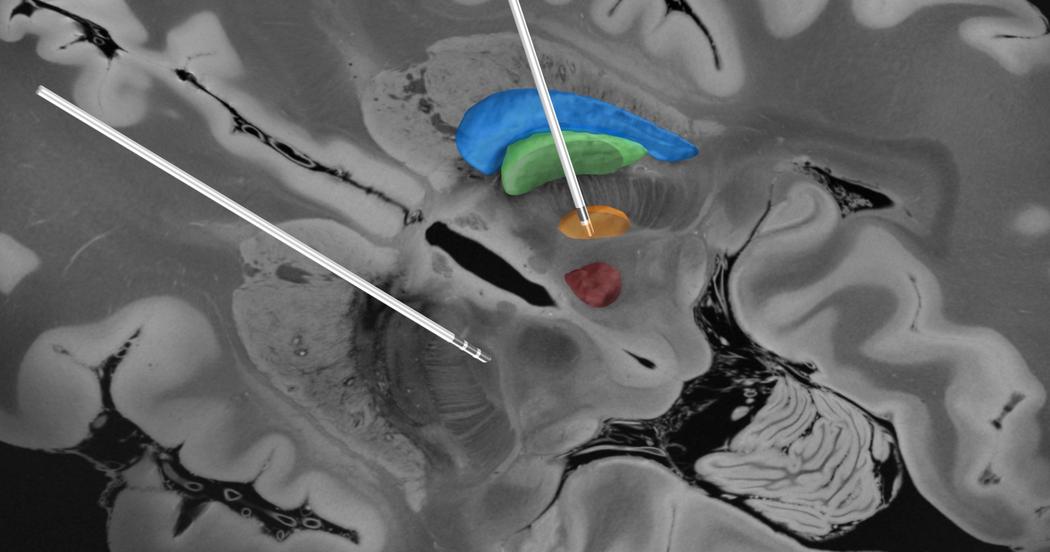 Deep Brain Stimulation – Lead-DBS