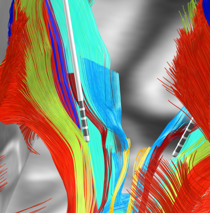 Subcortical Atlases (MNI-Space) – Lead-DBS