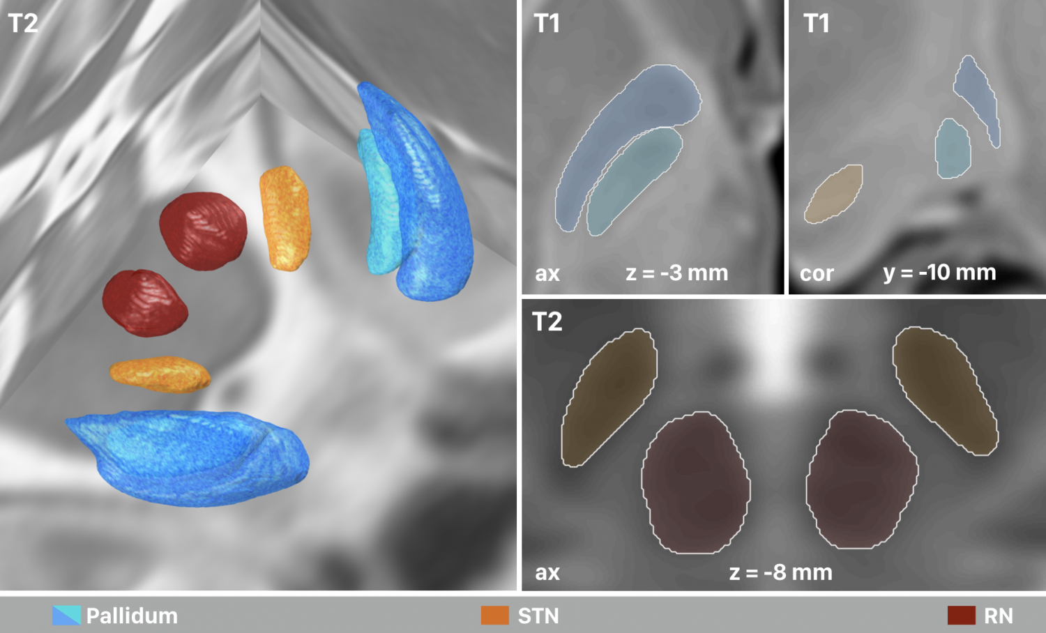 The DISTAL atlas – Lead-DBS