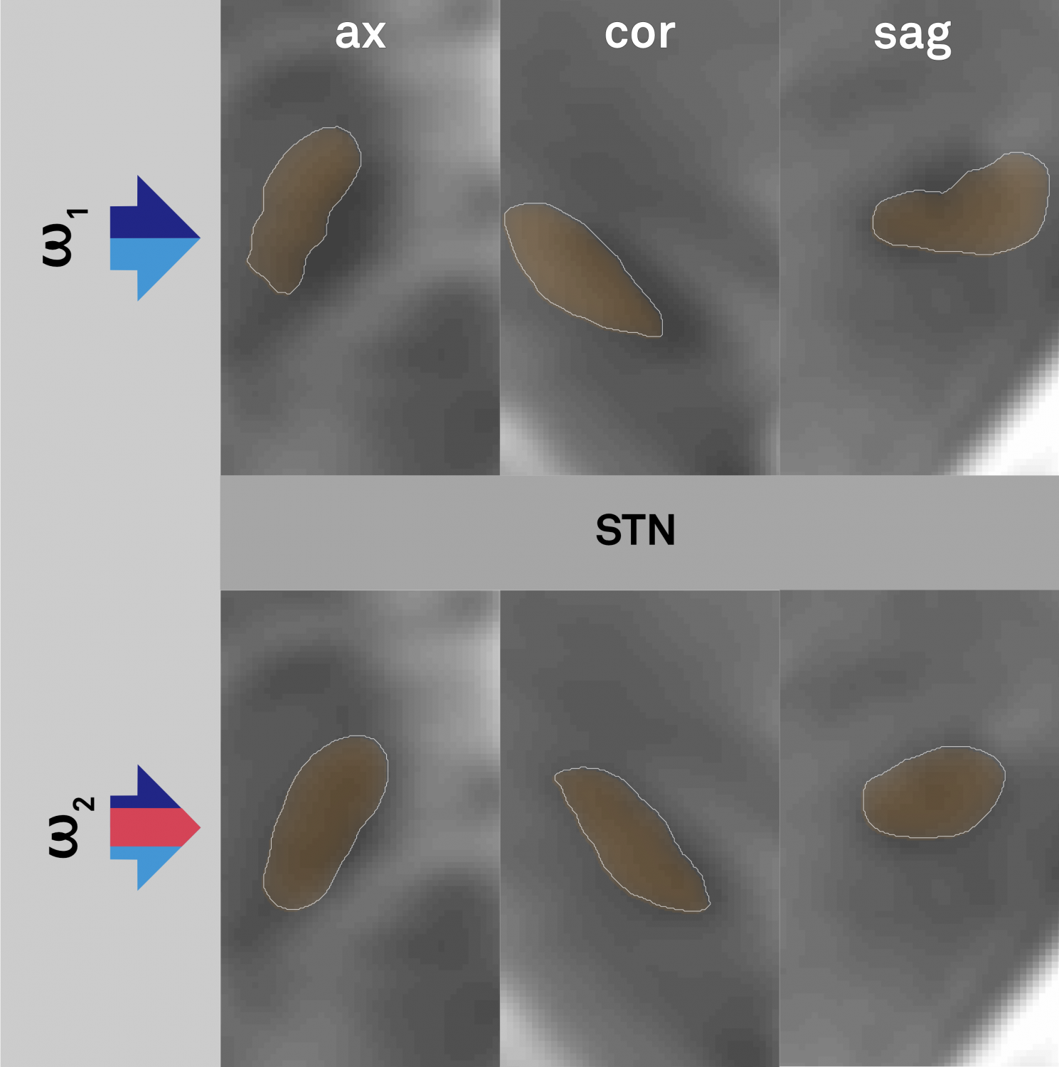 The DISTAL atlas – Lead-DBS
