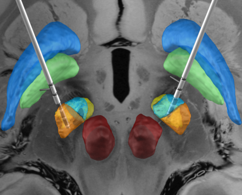 Lead-DBS – A MATLAB toolbox facilitating reconstruction and ...