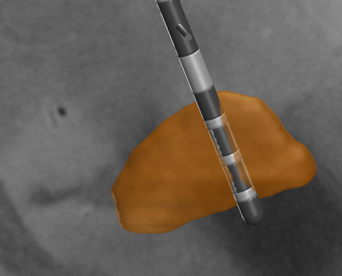 Lead-DBS – A MATLAB toolbox facilitating reconstruction and ...