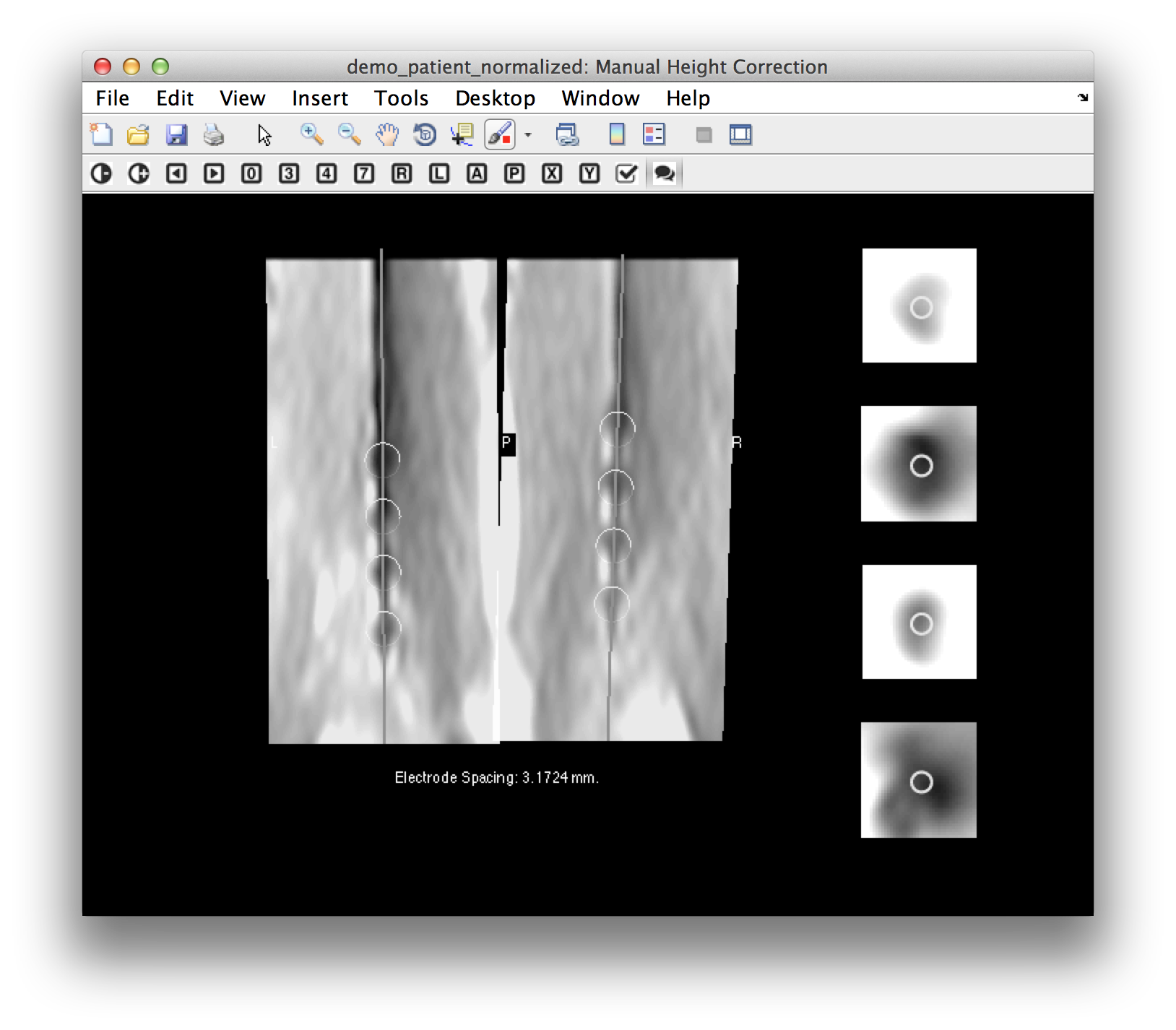 Screenshots – Lead-DBS