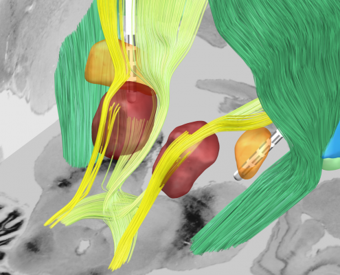 Lead-DBS – A Matlab toolbox reconstruction and visualization of DBS ...
