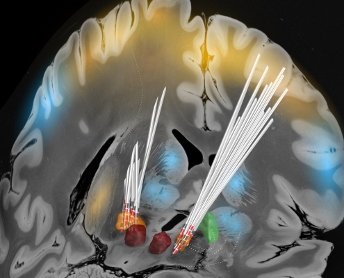 Lead-DBS – A Matlab toolbox reconstruction and visualization of DBS ...