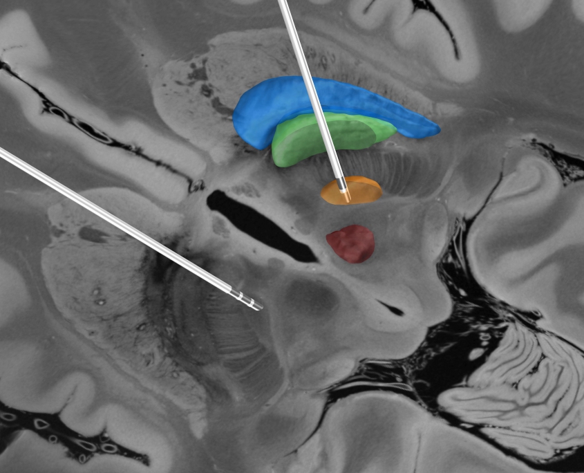 Lead Dbs A Matlab Toolbox Reconstruction And Visualization Of Dbs Electrodes Based On