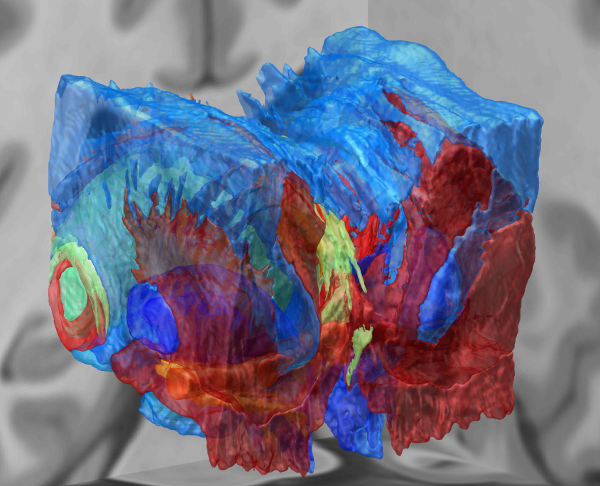 Lead-DBS – A Matlab toolbox reconstruction and visualization of DBS ...