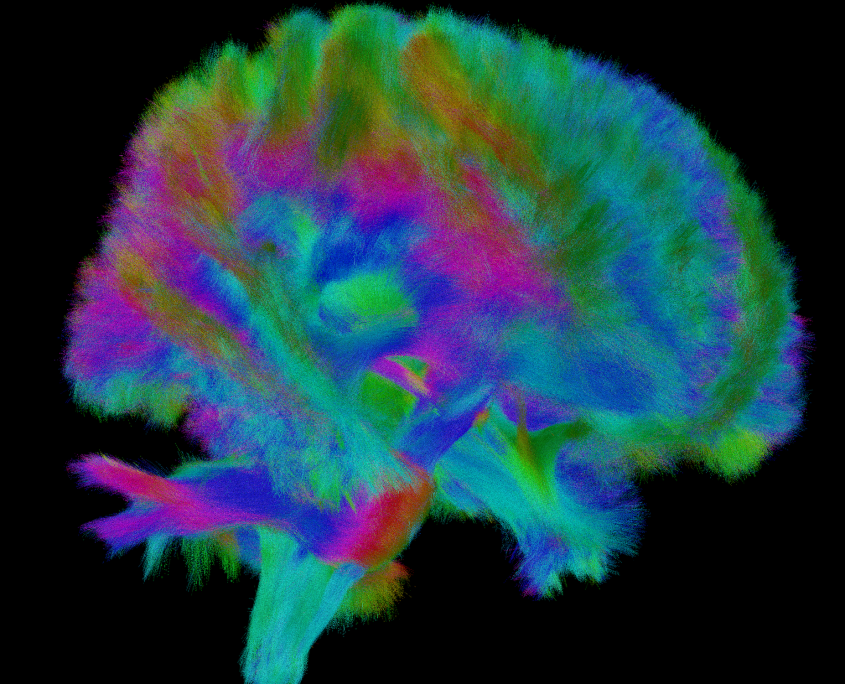 Lead-DBS – A Matlab toolbox reconstruction and visualization of DBS ...