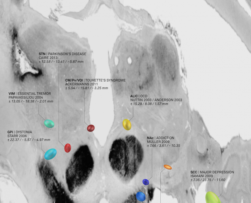 Lead Dbs A Matlab Toolbox Reconstruction And Visualization Of Dbs Electrodes Based On
