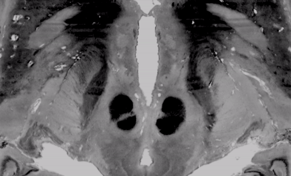 About the MNI space(s) – Lead-DBS