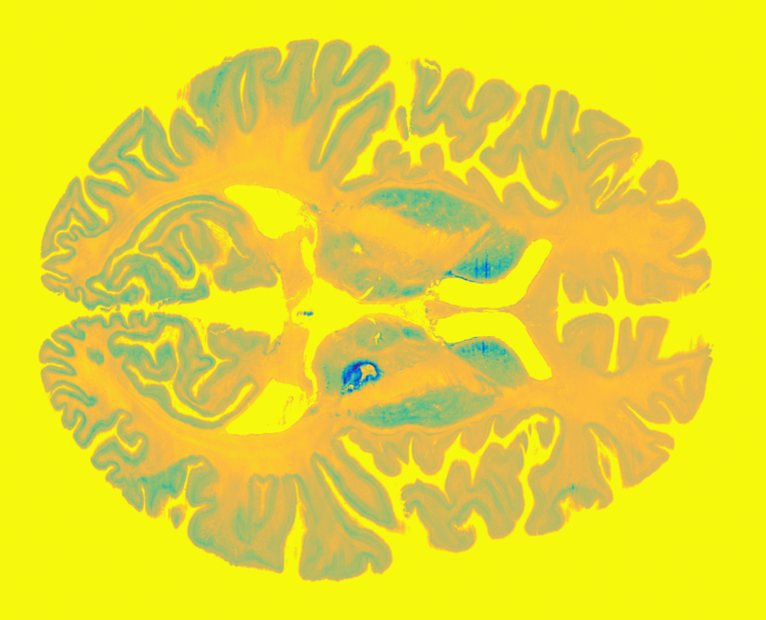 Lead-DBS – A Matlab toolbox reconstruction and visualization of DBS ...