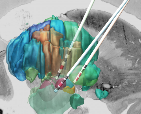 Lead-DBS – A Matlab toolbox reconstruction and visualization of DBS ...
