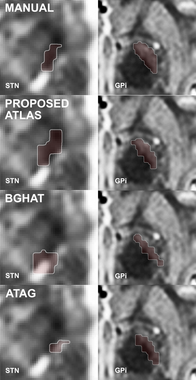 The DISTAL atlas – Lead-DBS