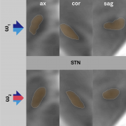 The DISTAL atlas – Lead-DBS