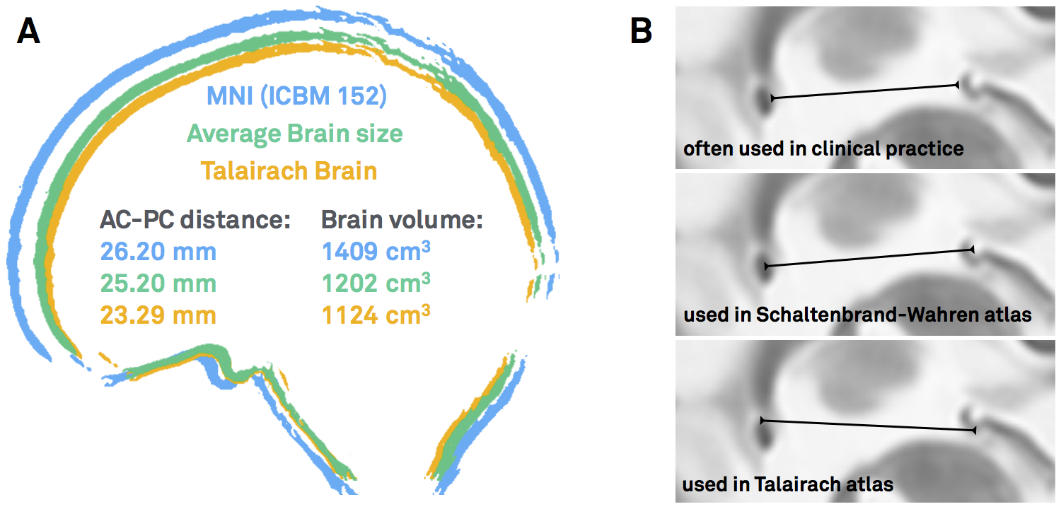 DBS targets in MNI space – Lead-DBS