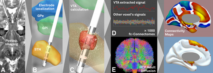 DBS Network Mapping – Lead-DBS