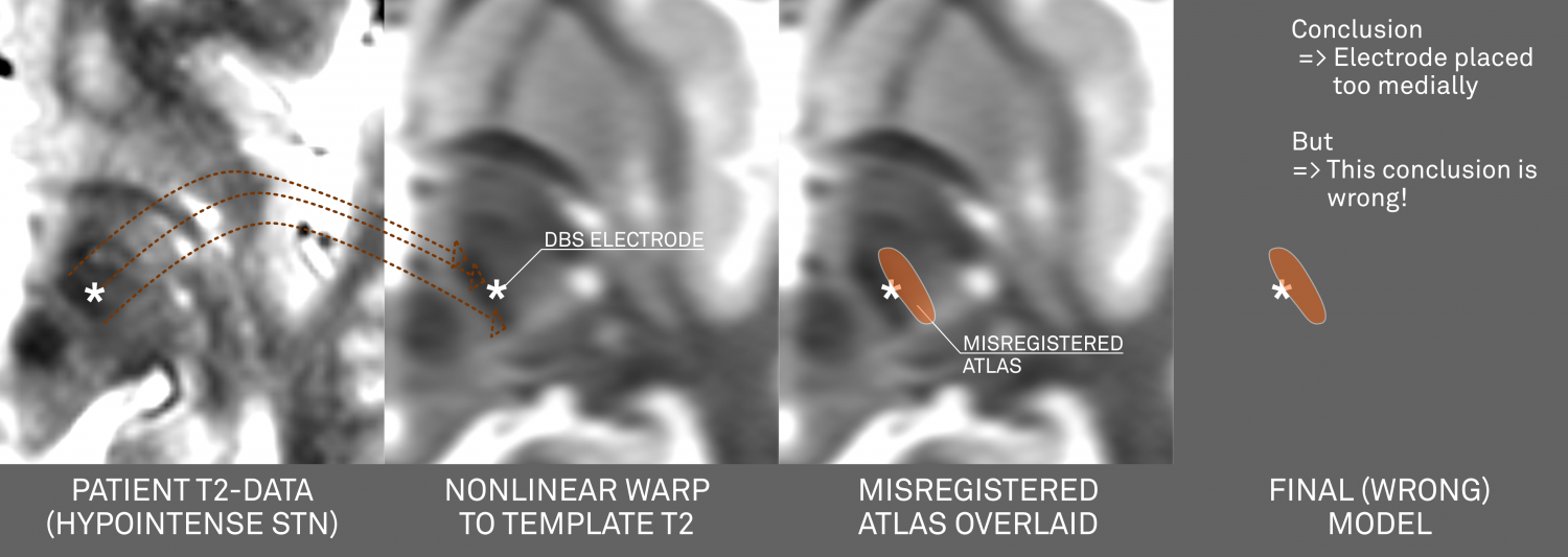 The DISTAL atlas – Lead-DBS