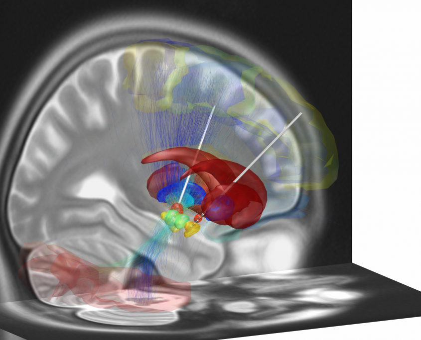 Lead Dbs A Matlab Toolbox Reconstruction And Visualization Of Dbs Electrodes Based On